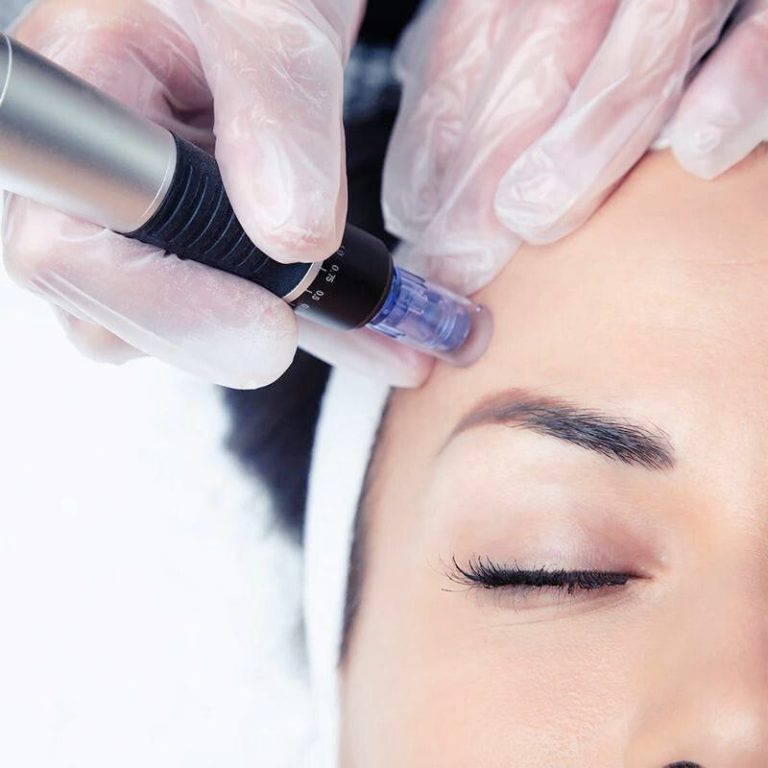 SkinPen® Microneedling - Skinplicity Medical Spa